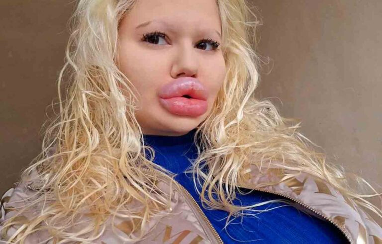 Ondanks Weigering Dokter, Vrouw met 'Grootste Lippen ter Wereld' Ondergaat Zes Procedures op Één Dag