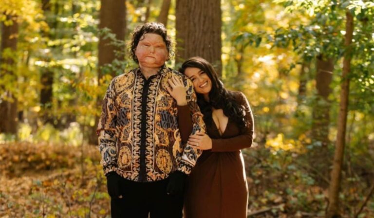 Primeiro homem do mundo a fazer implante de face e mãos anuncia ...